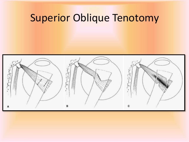Superior Oblique Tenotomy Superior Labral Anterior Posterior Lesions