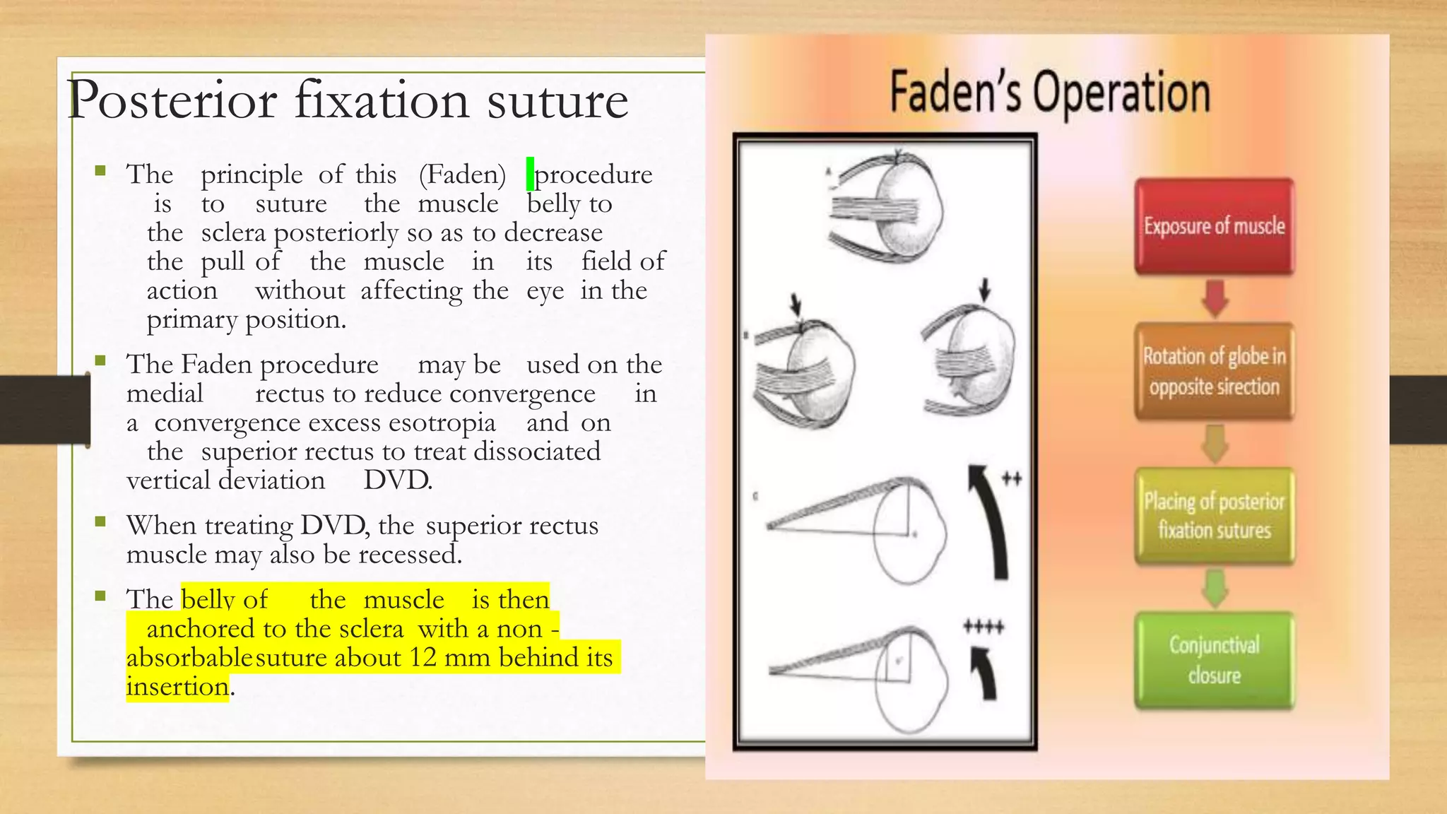 Squint surgeries | PPTX