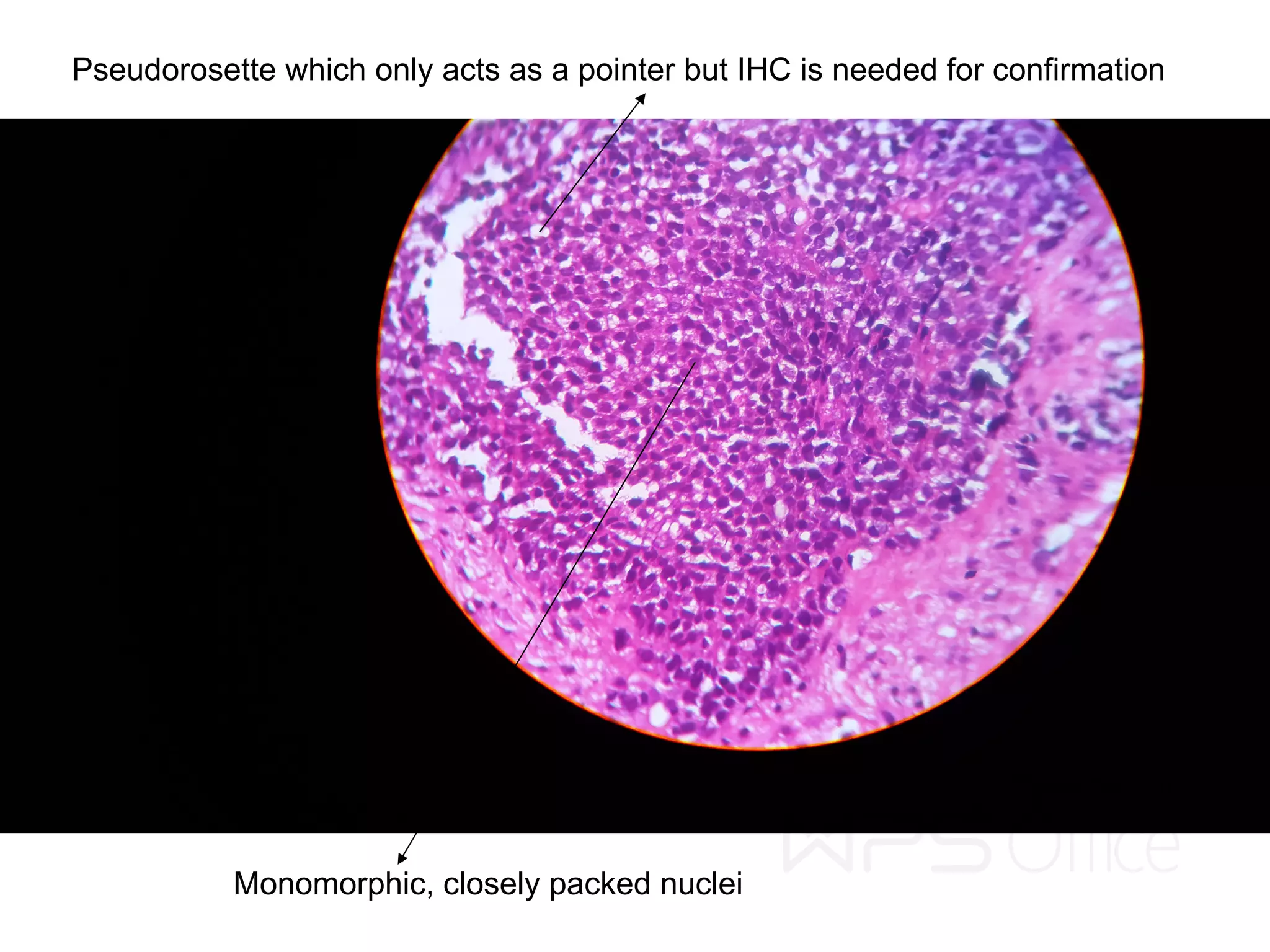 Histology of Small Round Blue Cell Tumor (SRBCT) | PDF