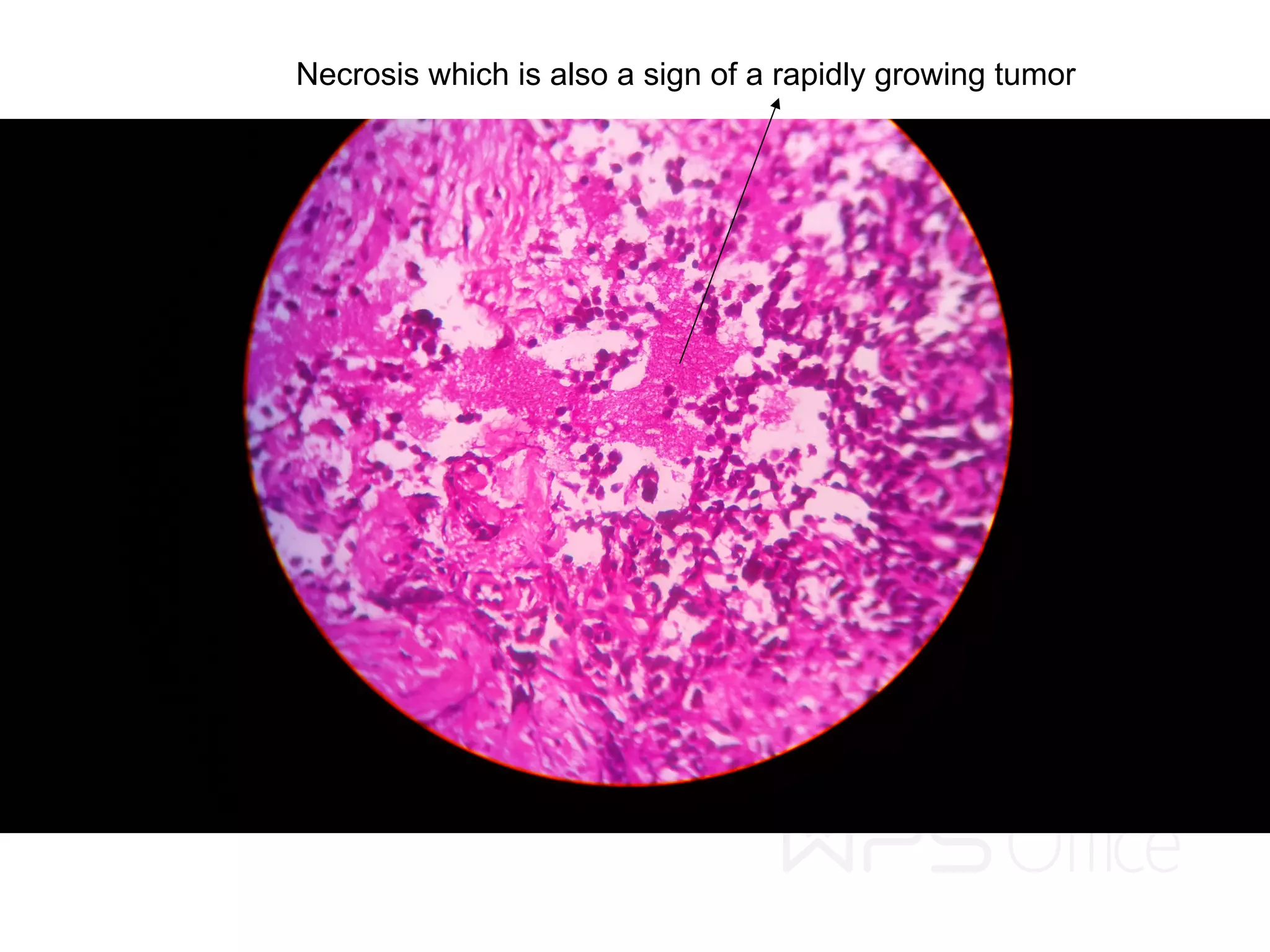 Histology of Small Round Blue Cell Tumor (SRBCT) | PDF