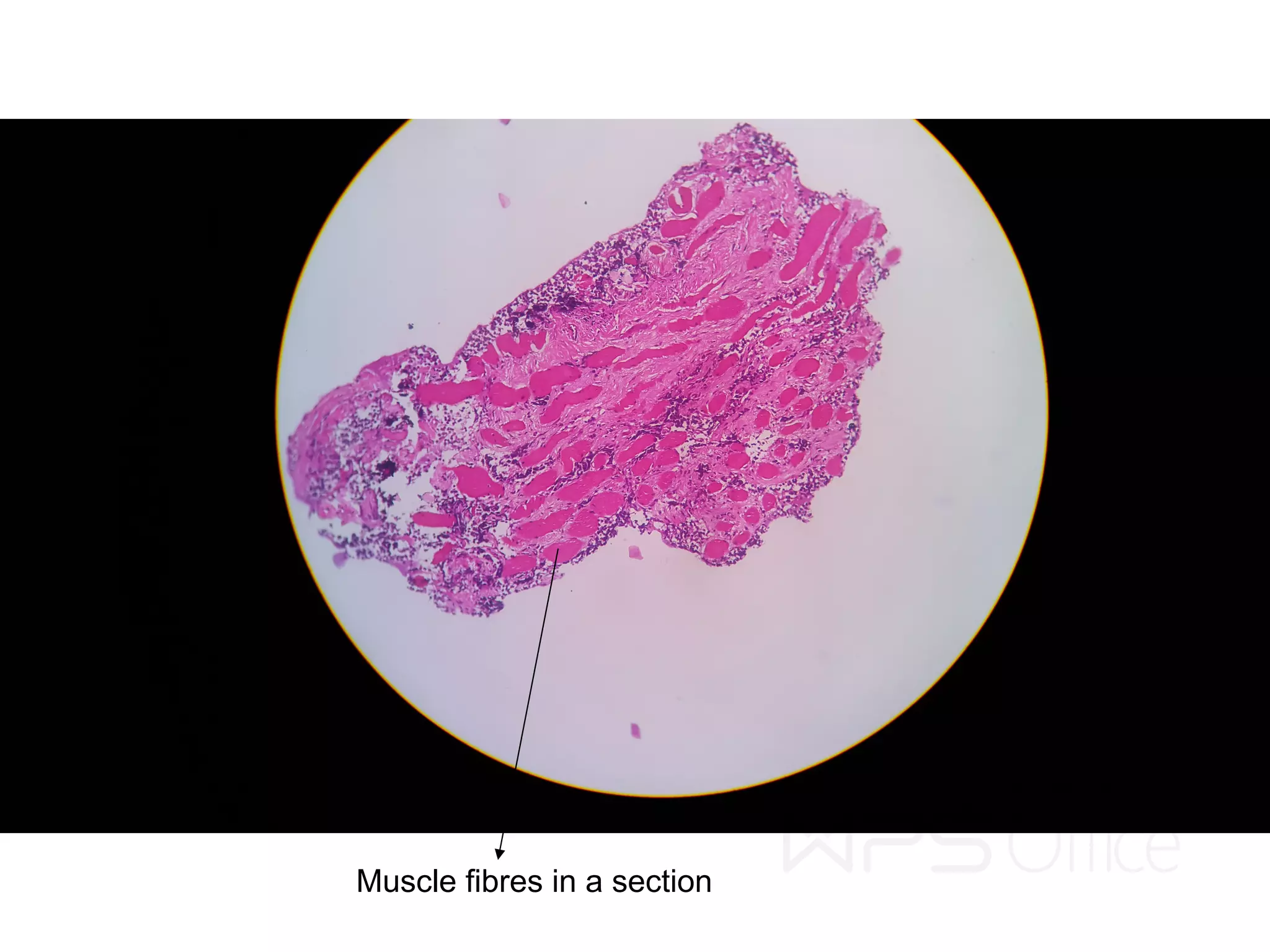Histology of Small Round Blue Cell Tumor (SRBCT) | PDF