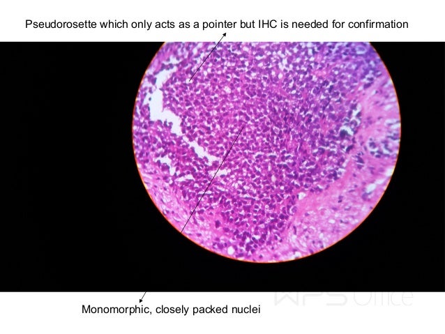 Histology Of Small Round Blue Cell Tumor Srbct