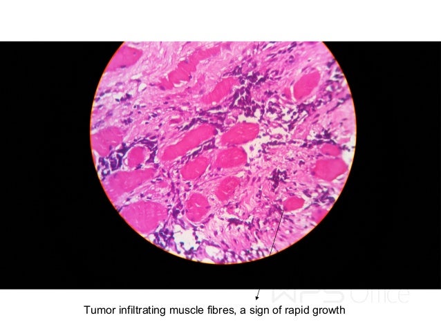 Histology Of Small Round Blue Cell Tumor Srbct