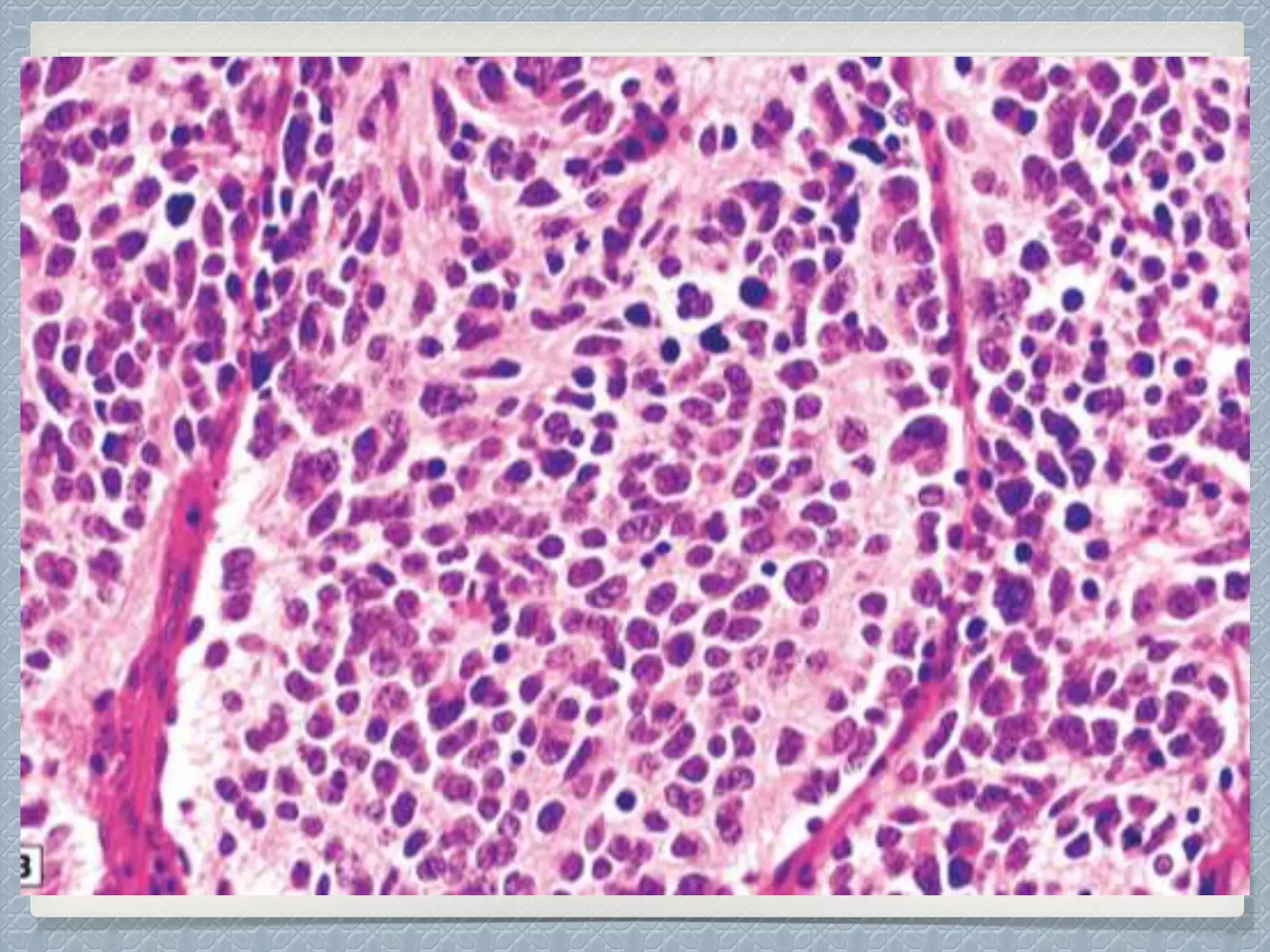 Small round cell tumors | PPTX