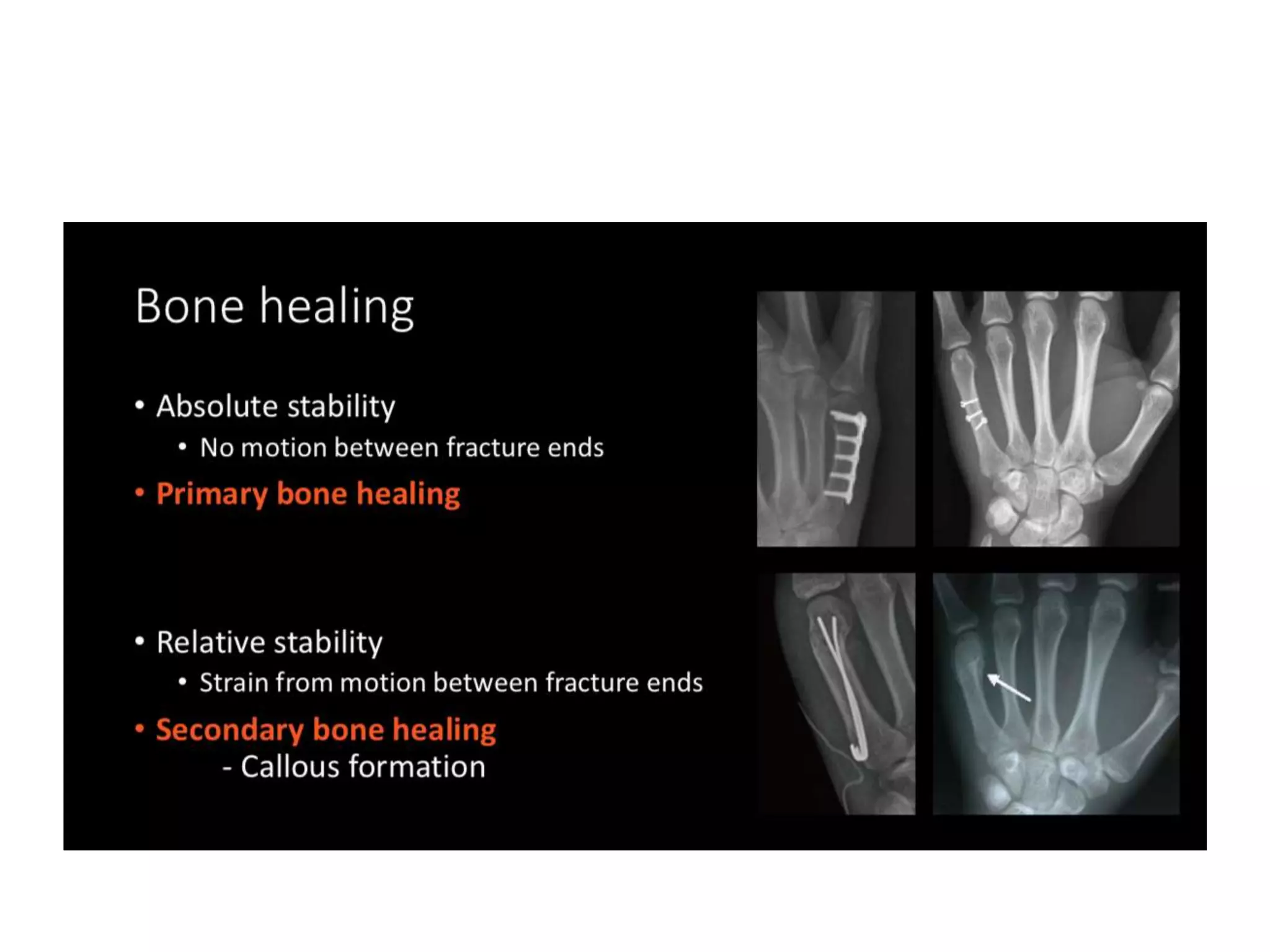 Bone Healing And Hand Fractures Pptx