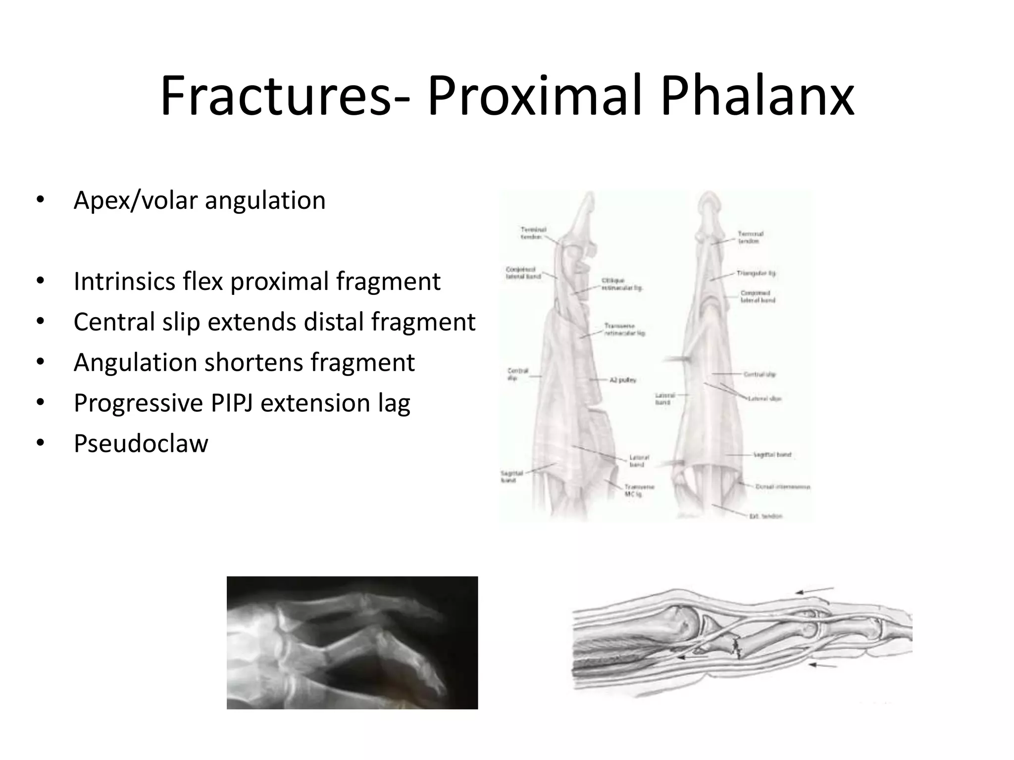 Bone healing and hand fractures | PPTX