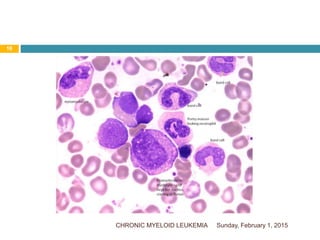 chronic myeloid leukemia | PPT