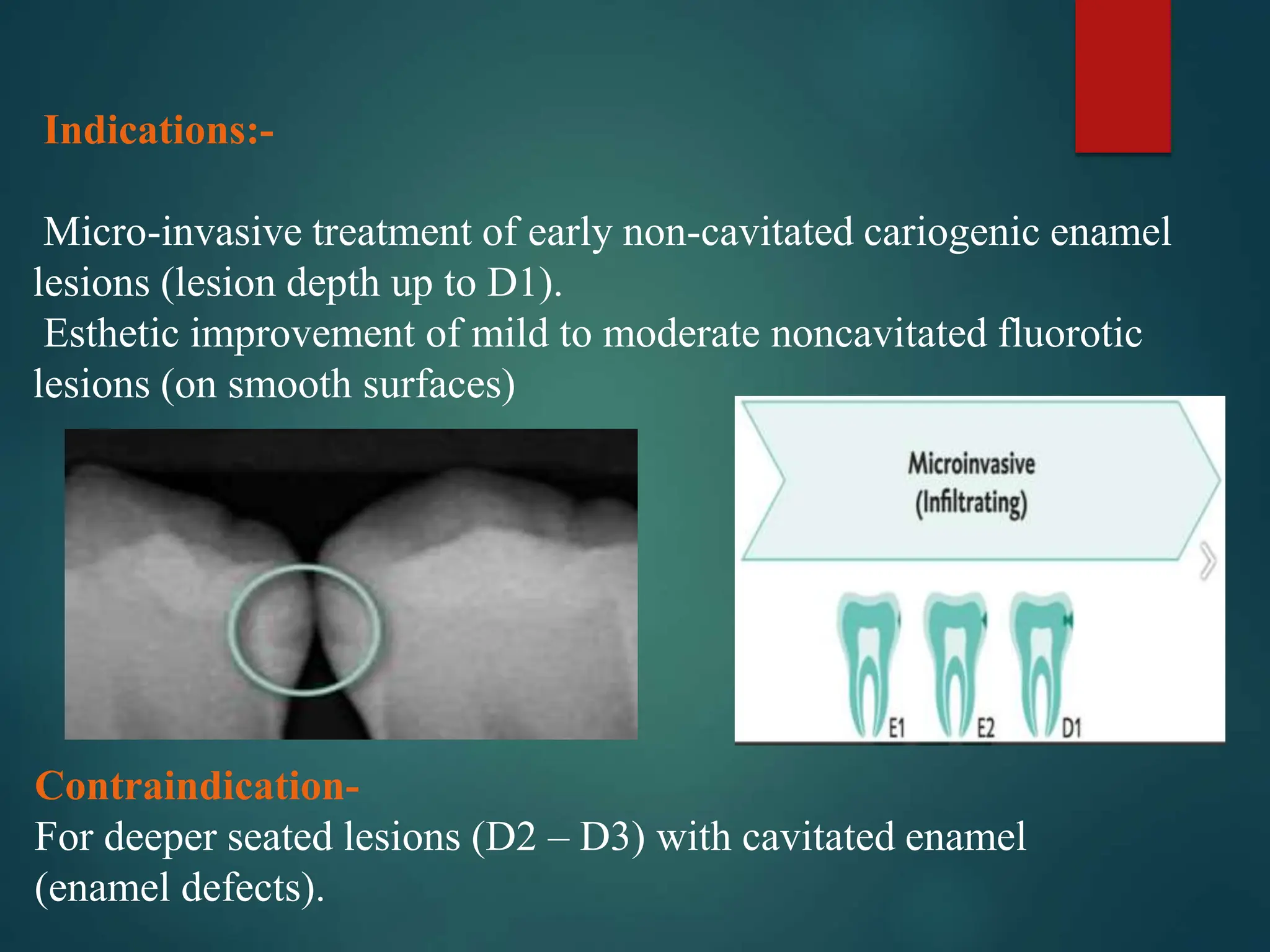srin new point.pptx about icon caries detector infiltrant dye | PPTX