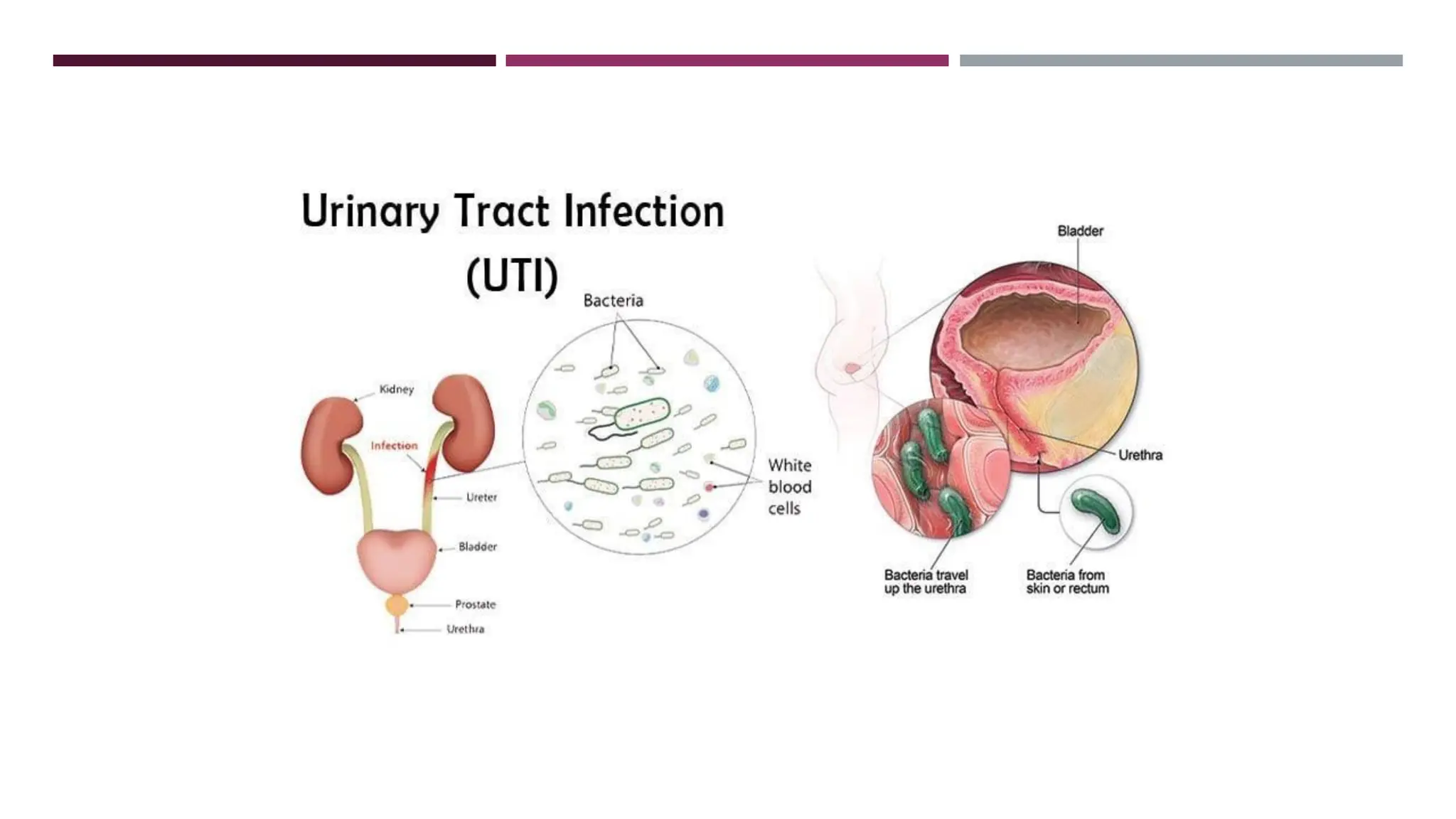 IDENTIFICATION OF PROBABLE URINARY TRACT INFECTIONINCHILDRENUSING LOW ...