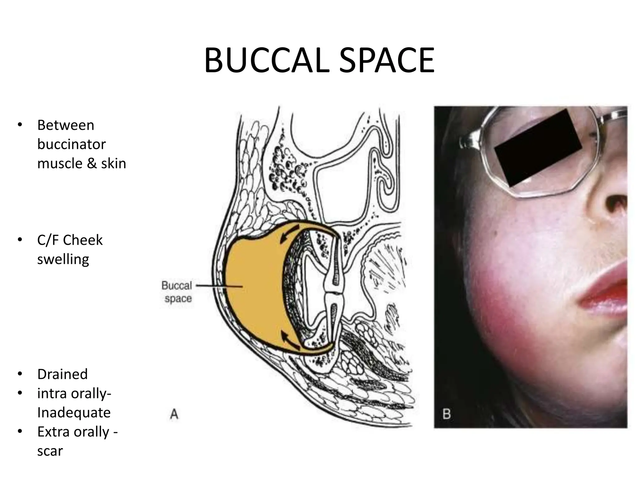 srp head and neck space infections UG.pptx