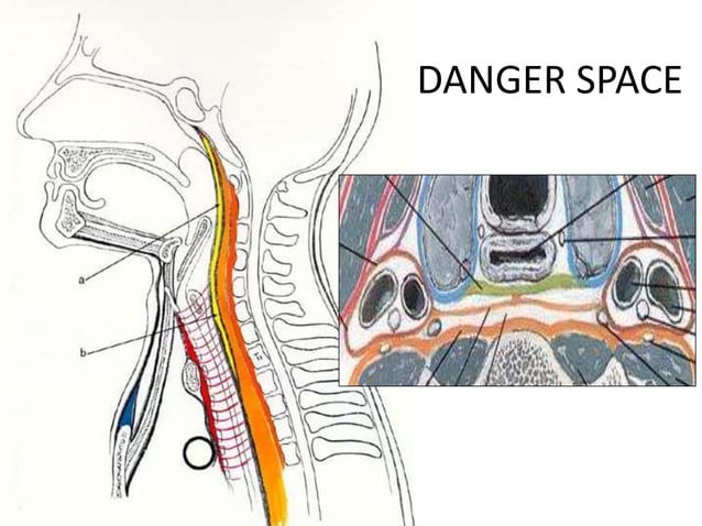 srp head and neck space infections UG.pptx