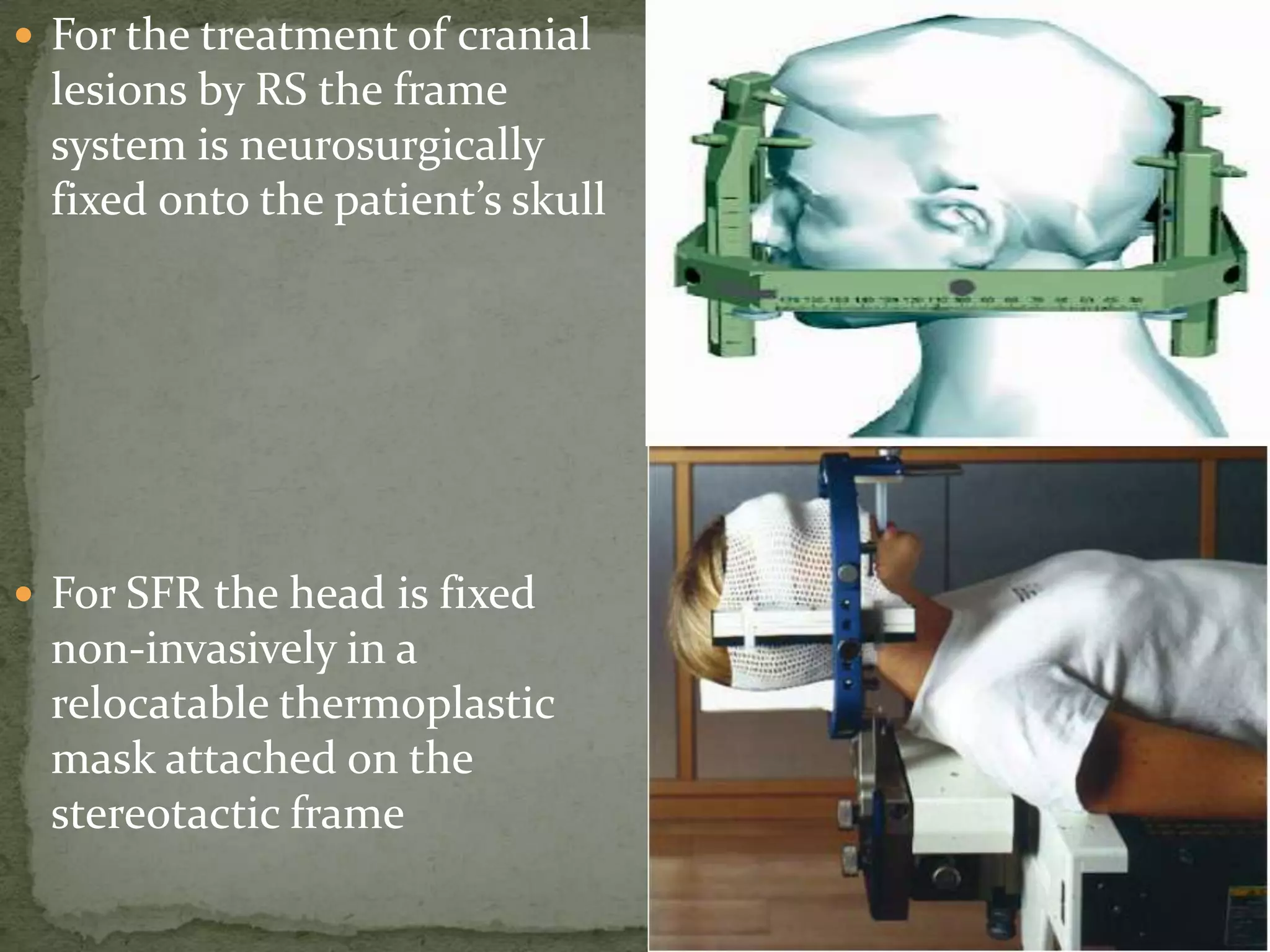 Stereotactic Radiosurgery/ Radiotherapy | PPTX