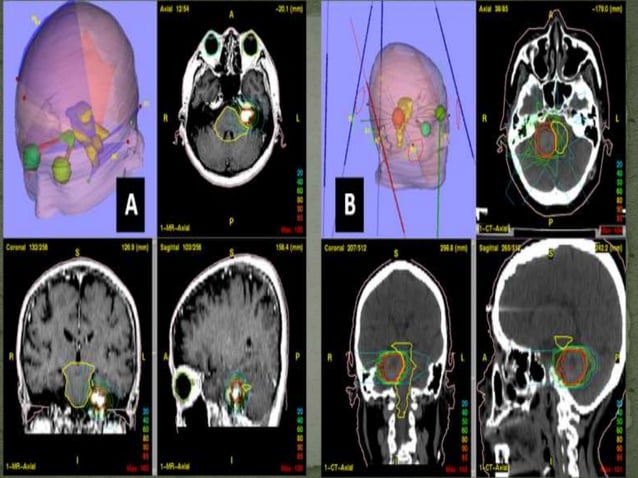 Stereotactic Radiosurgery/ Radiotherapy | PPTX | Cancer | Diseases and ...