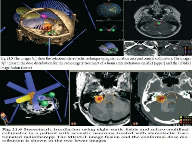 Stereotactic Radiosurgery/ Radiotherapy