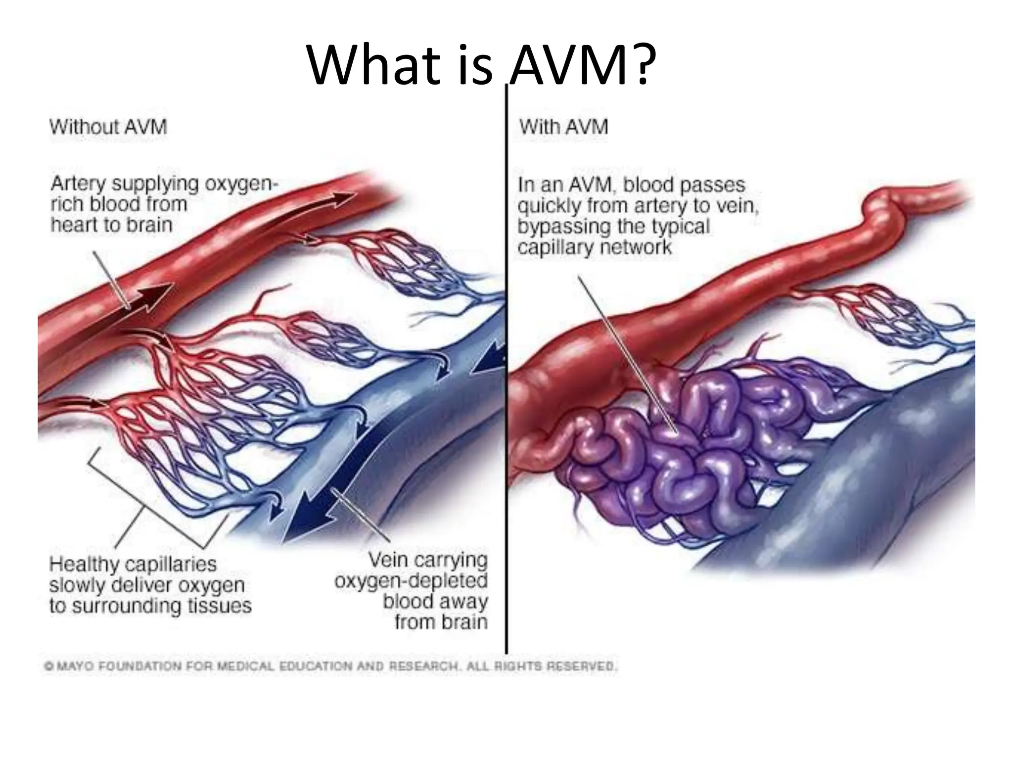 WHY STEREOTATXY IN CRANIAL AVM / DR KANHU CHARAN PATRO | PPTX | Brain and Nervous System ...