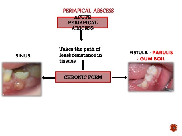 Infamattion in Dentistry (Dept of public health Dentistry ) part 2