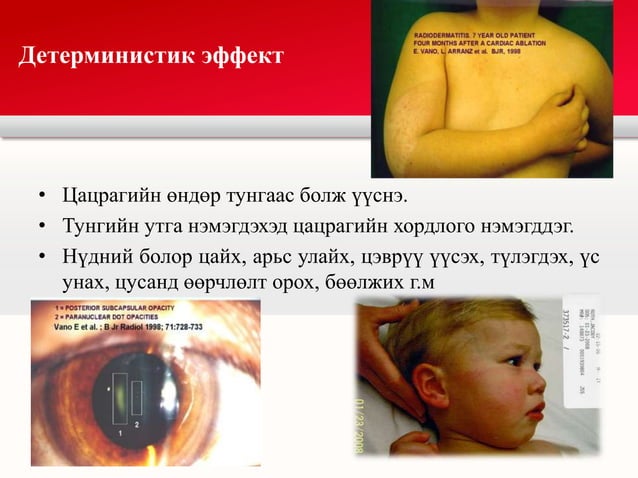рентген цацрагийн хамгаалалт