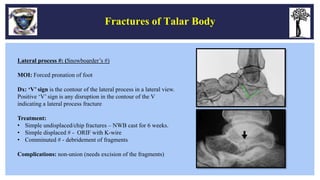 Fractures and Dislocations of Foot - Dr Sunkappa SR | PPTX
