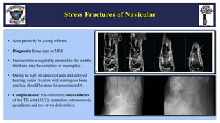 Fractures and Dislocations of Foot - Dr Sunkappa SR | PPTX
