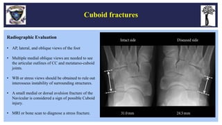 Fractures and Dislocations of Foot - Dr Sunkappa SR | PPTX