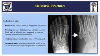 Fractures and Dislocations of Foot - Dr Sunkappa SR | PPTX