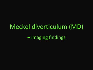 Meckel diverticulum - imaging findings | PPTX