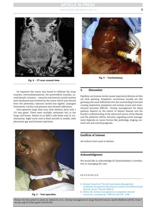 Airway management is large thyroid tumors | PDF