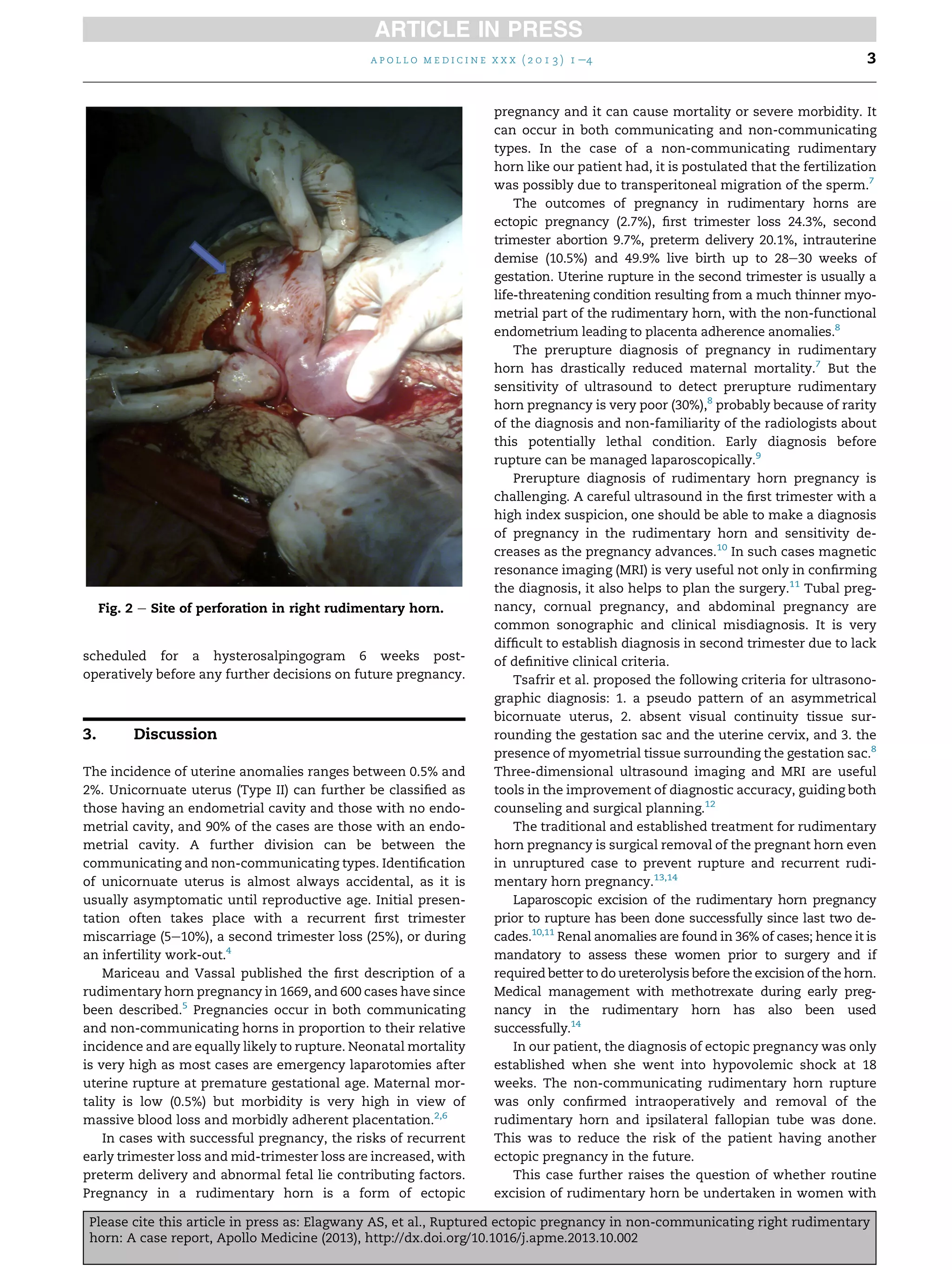 Ruptured ectopic pregnancy in non-communicating right rudimentary horn ...