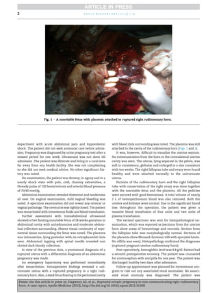 Ruptured ectopic pregnancy in non-communicating right rudimentary horn ...