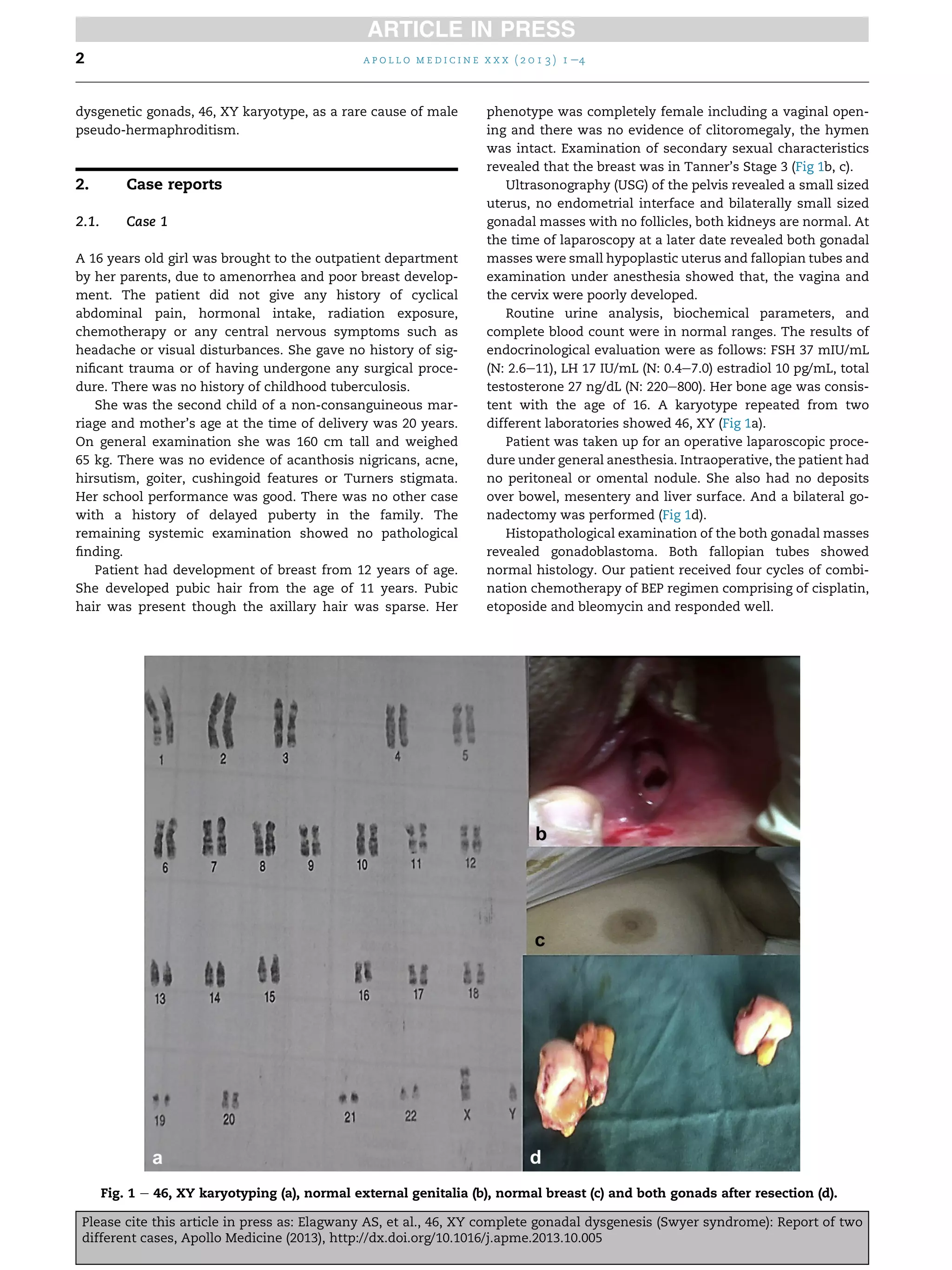 46, XY complete gonadal dysgenesis (Swyer syndrome): Report of two ...