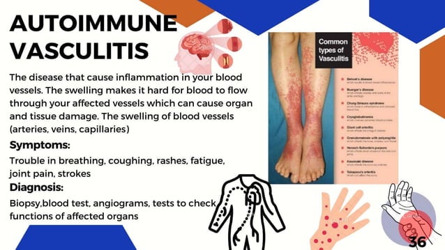 AUTOIMMUNE DISORDERS (ORGAN SPECIFIC & SYSTEM SPECIFIC) | PPTX