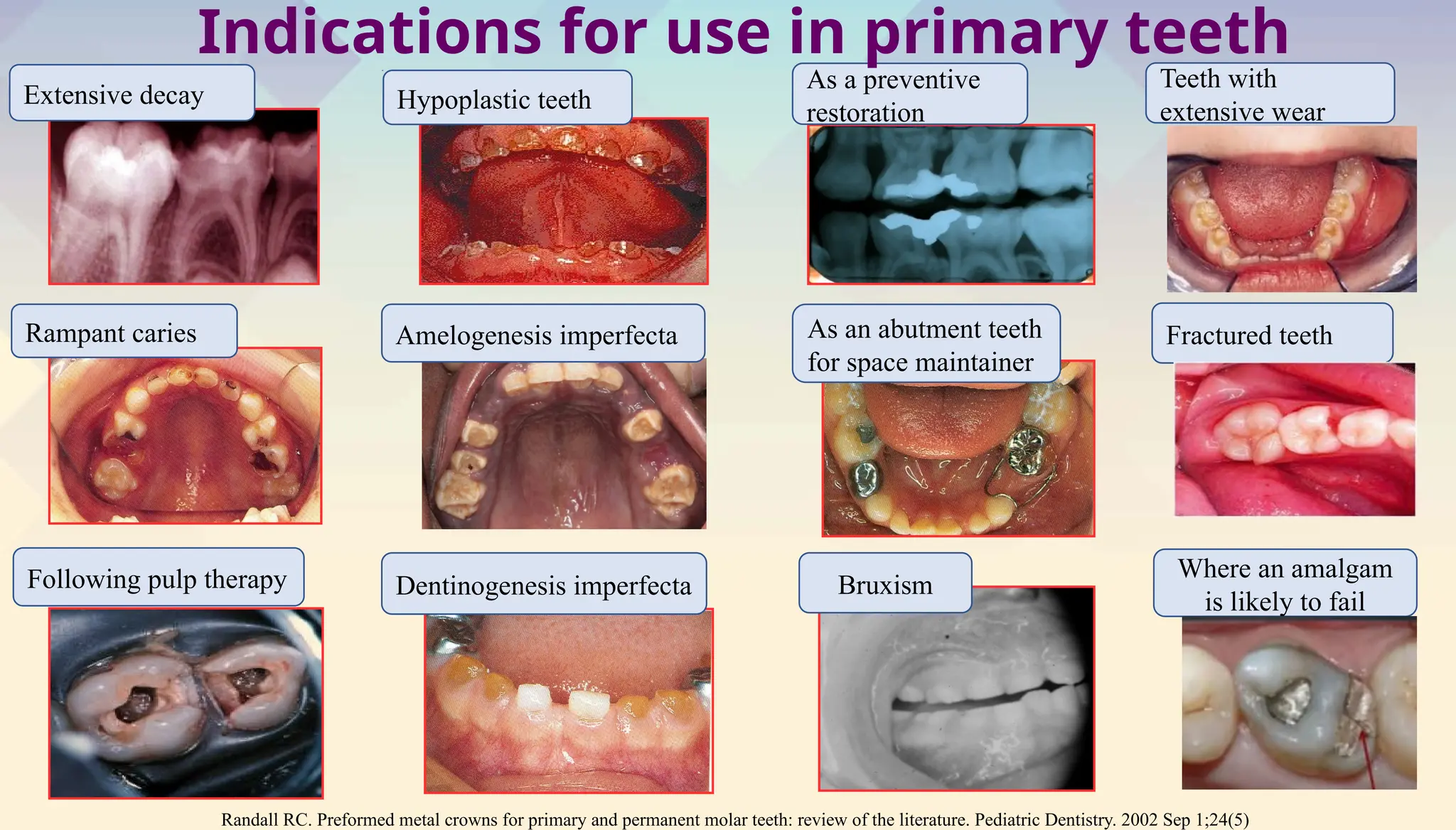 stainless steel crowns in pediatric dentistry | PPTX