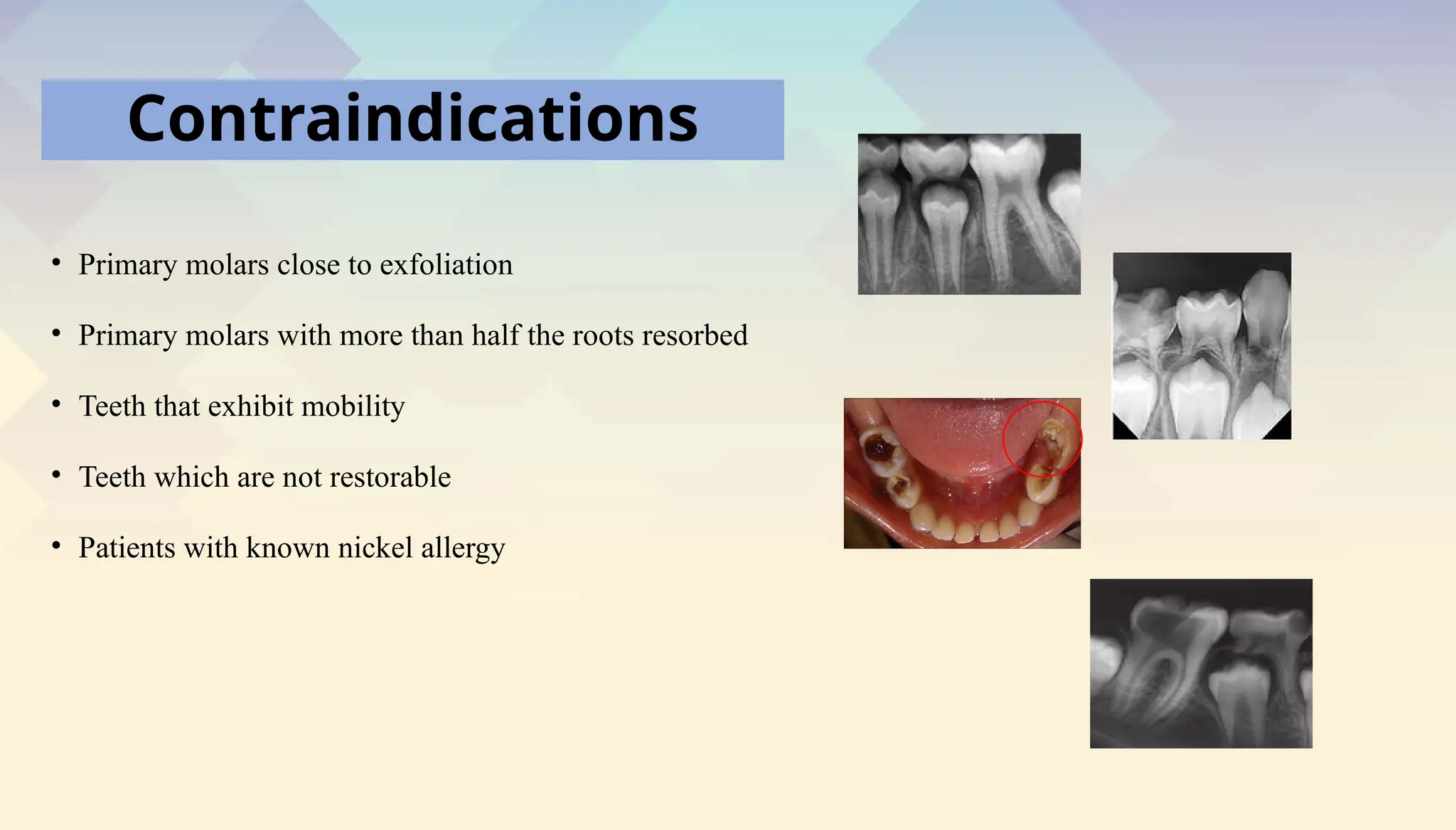 stainless steel crowns in pediatric dentistry | PPTX