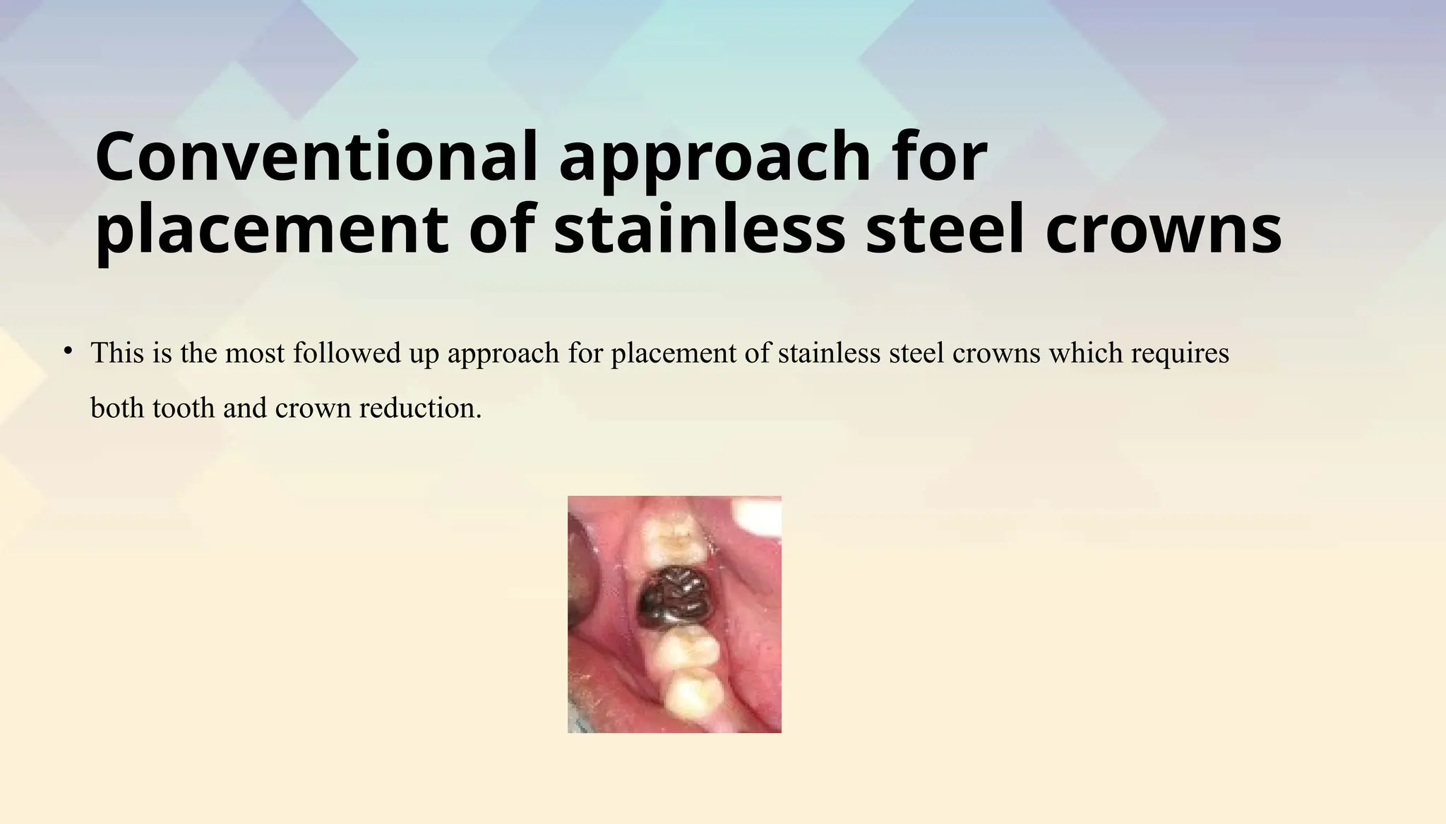 stainless steel crowns in pediatric dentistry | PPTX