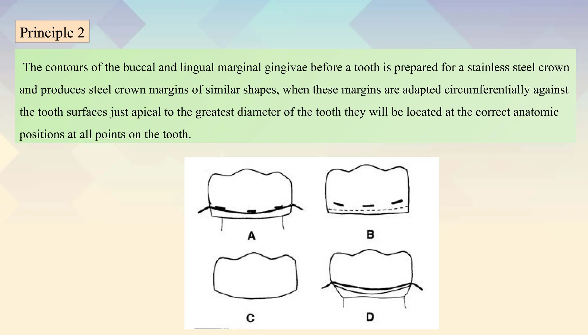 stainless steel crowns in pediatric dentistry | PPTX