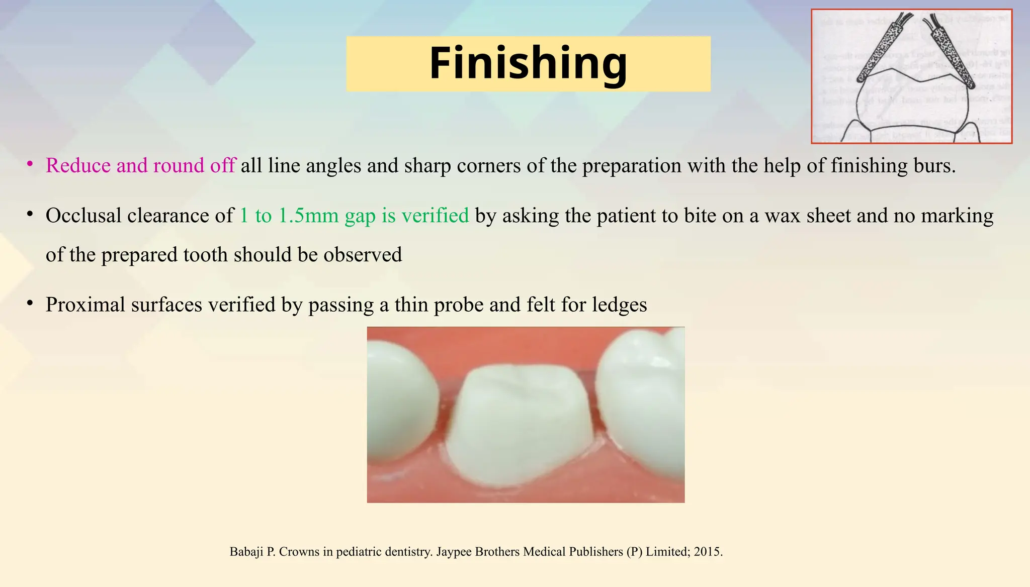 stainless steel crowns in pediatric dentistry | PPTX