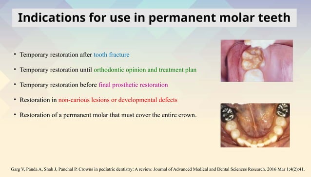 stainless steel crowns in pediatric dentistry | PPTX | Dental Health ...