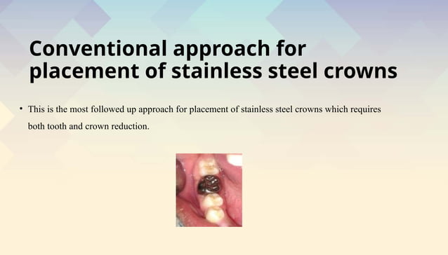 stainless steel crowns in pediatric dentistry | PPTX | Dental Health ...