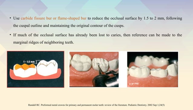 stainless steel crowns in pediatric dentistry | PPTX | Dental Health ...