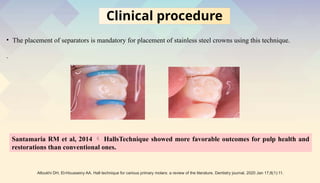 stainless steel crowns in pediatric dentistry | PPTX
