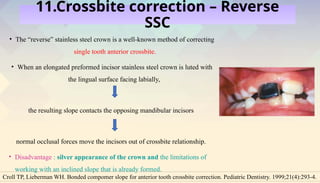 stainless steel crowns in pediatric dentistry | PPTX