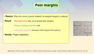 stainless steel crowns in pediatric dentistry | PPTX