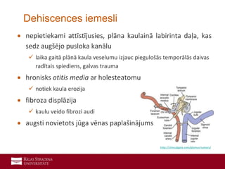 Augšējā pusloka kanāla dehiscence | PPTX