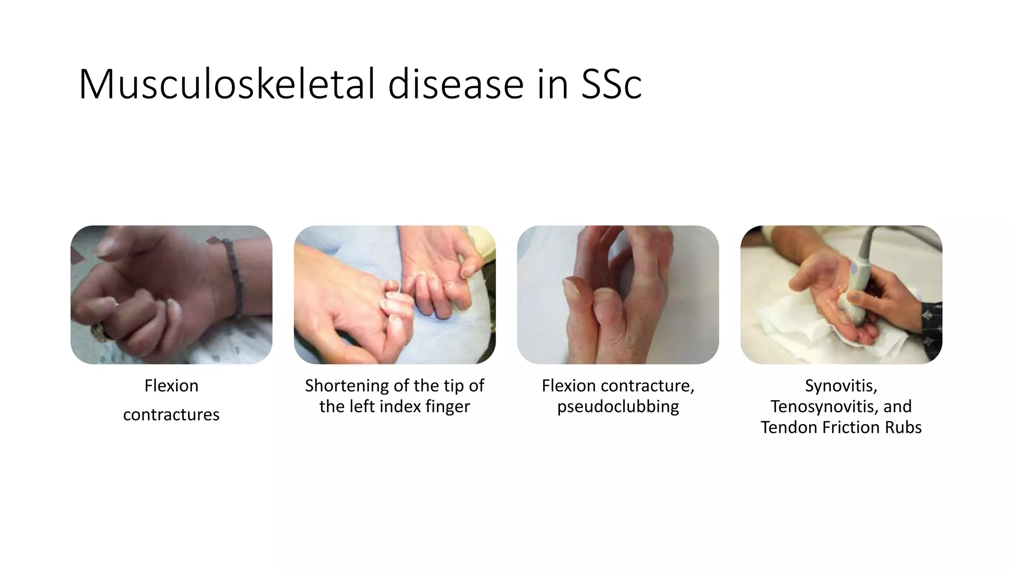 Systemic Sclerosis | PPTX