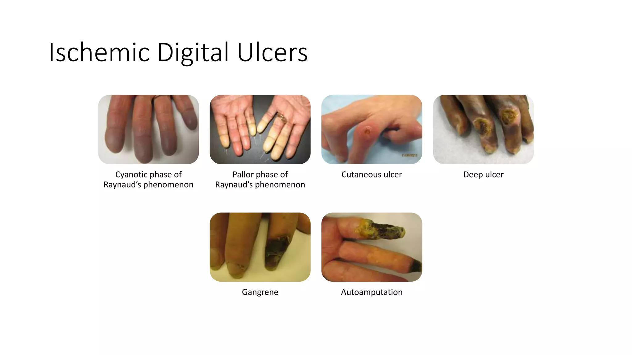 Systemic Sclerosis | PPTX