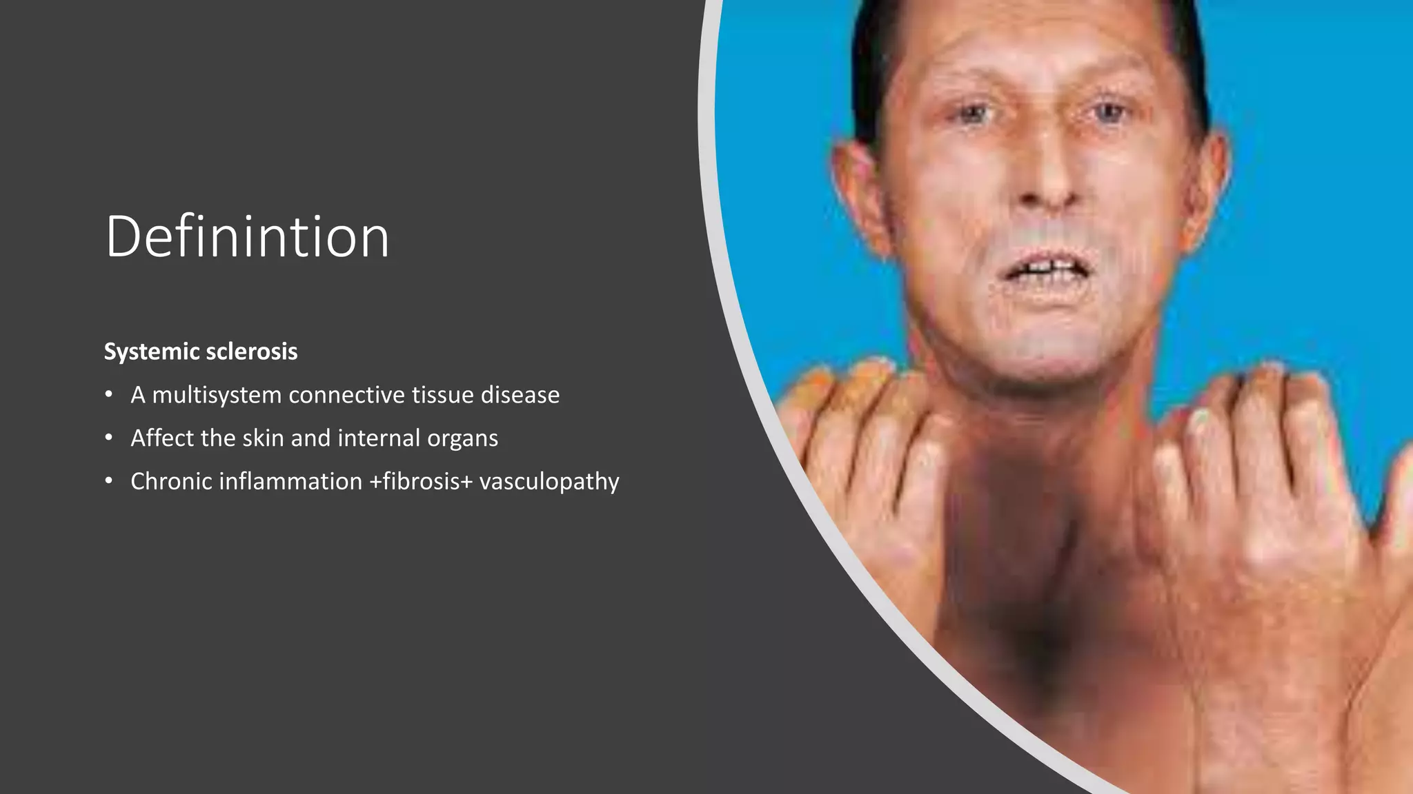 Systemic Sclerosis | PPTX
