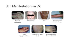 Systemic Sclerosis | PPTX
