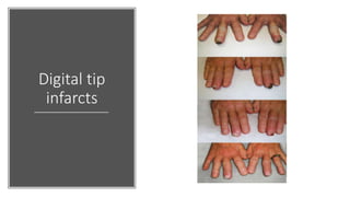 Systemic Sclerosis | PPTX