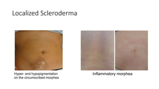Systemic Sclerosis | PPTX