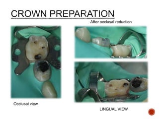 SS crown restoration | PPT